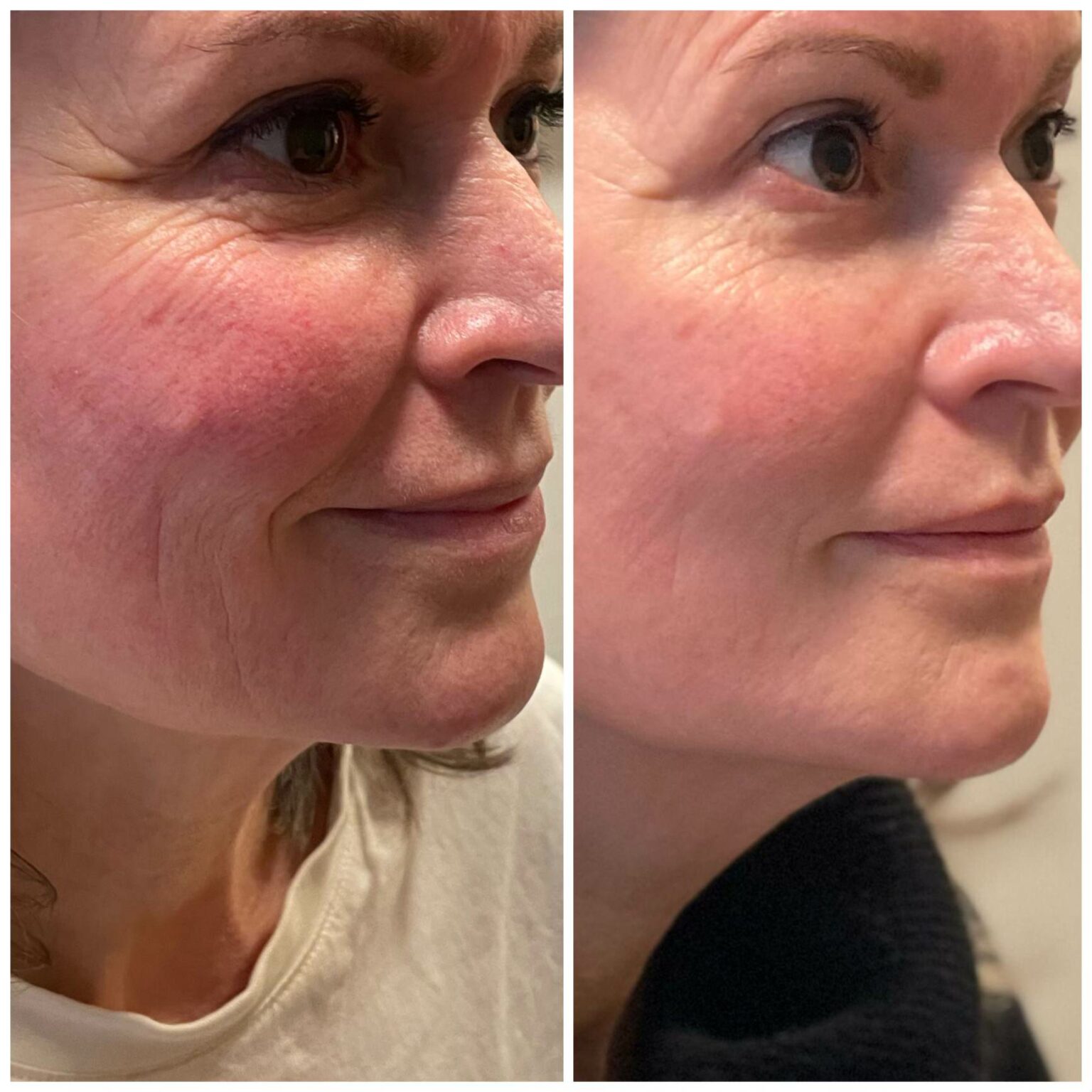 EM Shaper Face – Det ultimative facelift uden kirurgisk indgreb